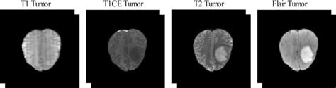 Sample images of different types of brain tumors⁵² Download Scientific Diagram
