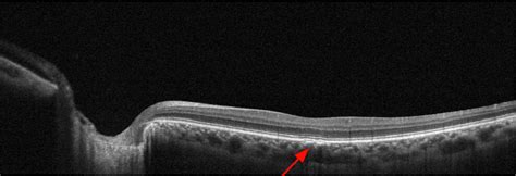 Exposing Hidden Lesions A Case Of Non Exudative Occult Cnv