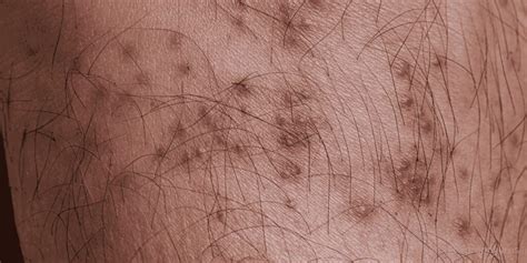 Tick Bite Prophylaxis Antibiotics When Needed Tips