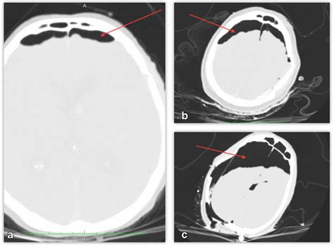 Postmortem Computed Tomography Pmct Multiplanar Reconstruction Mpr Download Scientific