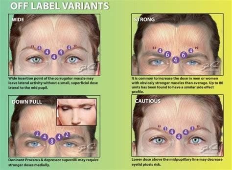 New Botox Pattern Should You Switch Dr Tim Pearce