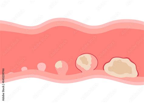 Stage Of Growth Polyp In Malignant Tumor Inside Wall Of Organ Risk