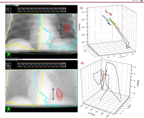 Figure 1 From Quantification Of Lung Tumor Motion And Optimization Of Treatment Semantic Scholar