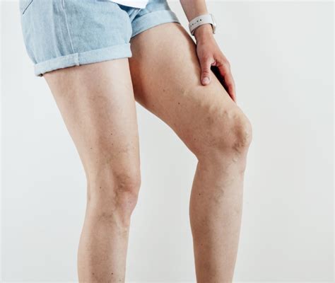 Tromboflebite Superficiale