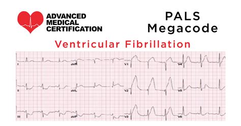 Pals Megacode Ventricular Fibrillation