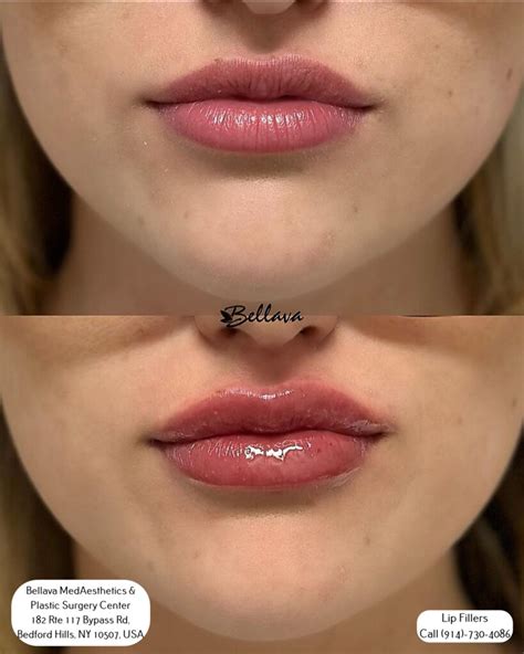 Achieving Natural Looking Lip Fillers A Guide To Fuller Lips Without
