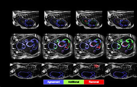 Comparison Of Automatic Segmentation Networks Performance Three