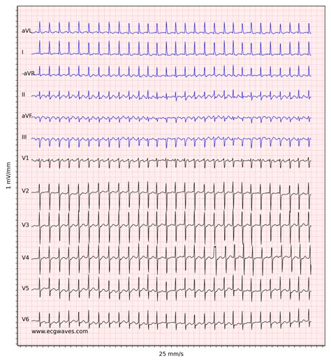 Atrial Flutter Classification Causes Ecg Diagnosis And Management