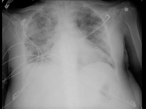 Chest X Ray Cardiomegaly With Diffuse Bilateral Interstitial