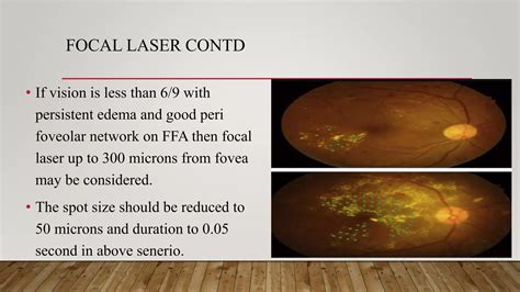 Basics Of Pan Retinal Sector And Focal Retinal Laser Photocoagulation Pptx