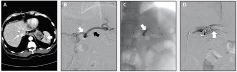 A Coil For Every Case Achieving Volume And Softness With The Penumbra Embolization Platform
