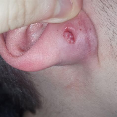 Problem With Back Of Ear Piercing Rpiercingadvice