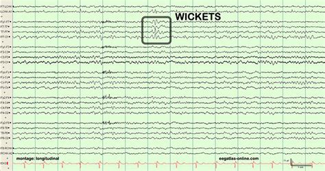 Eeg Basics Waveform Morphology