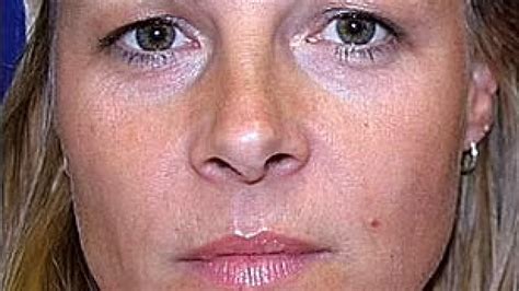 Identical Twins Shared Major Difference After One Used Botox For 20 Years And The Other Didnt