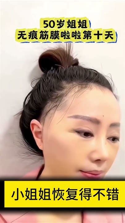 50岁小姐姐恢复10天后 太满意了 自信 开心 美女 整形 Youtube