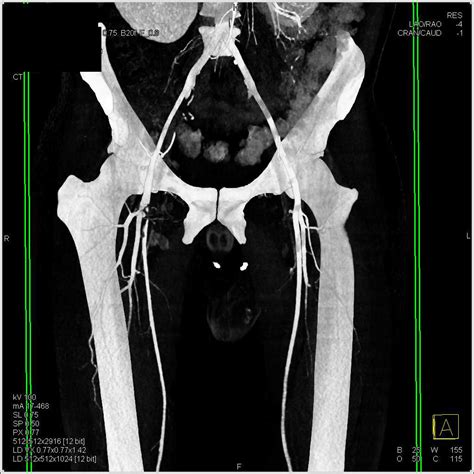 Superficial Femoral Artery Occlusion Image Radiopaediaorg