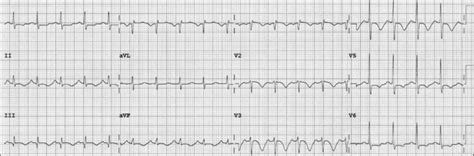 Pulmcrit Blogitorial Use Of Ecgs For Management Of Submassive Pe