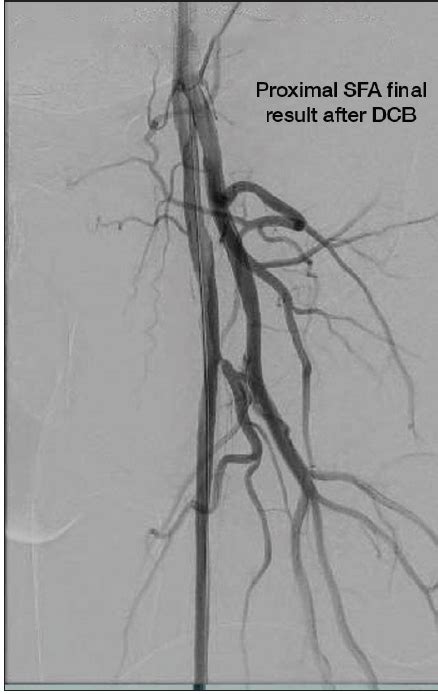 Case Report Retrograde Laser Crossing Of A Left Sfa Occlusion With An Ambiguous Proximal Cap
