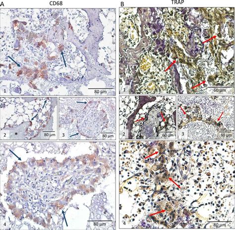 Localization Of Macrophages Cd68 And Foreign Body Giant Cells Fbgc