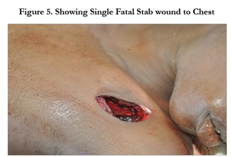 A Study Of Stab Wounds In Sexual Homicides