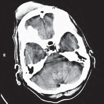 Cranial CT Normal Findings Radiology Key