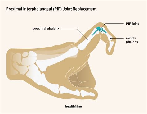 Proximal Interphalangeal Pip Joint Arthroplasty