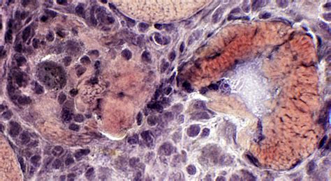 Trichinosis Acute