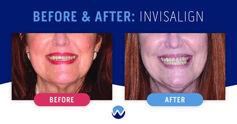 Active Aligners Before And After At George Ashcraft Blog