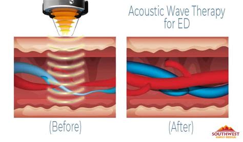 Acoustic Wave Therapy For Erectile Dysfunction Ed Treatment