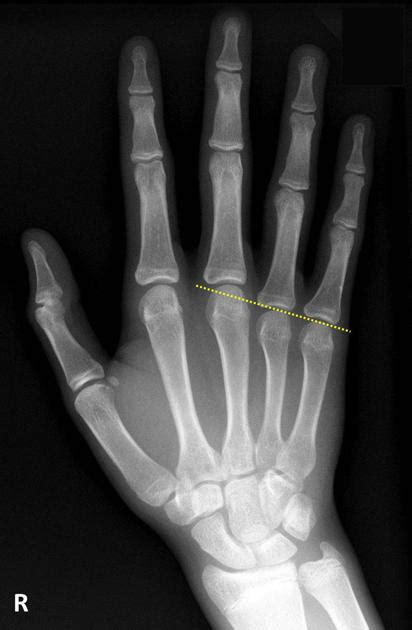 Metacarpal Sign Pacs