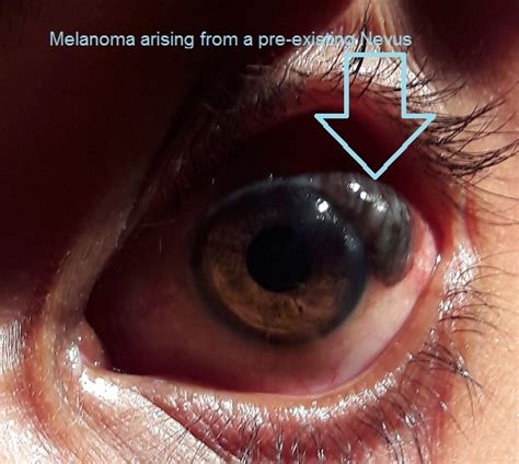 Can We Stop Conversion Of A Nevus Into Malignant Melanoma Researchgate