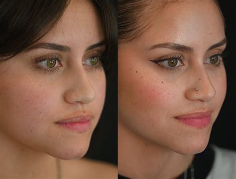 Chin Reduction Beverly Hills Ca And Los Angeles Dr Sykes
