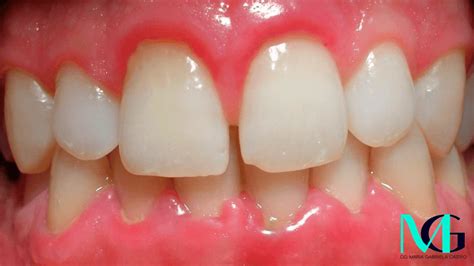 Comprendiendo La Gingivitis Causas Síntomas Y Opciones De Tratamiento
