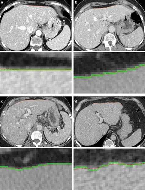 Examples Of Liver Surface Nodularity Lsn Scores Derived From Routine