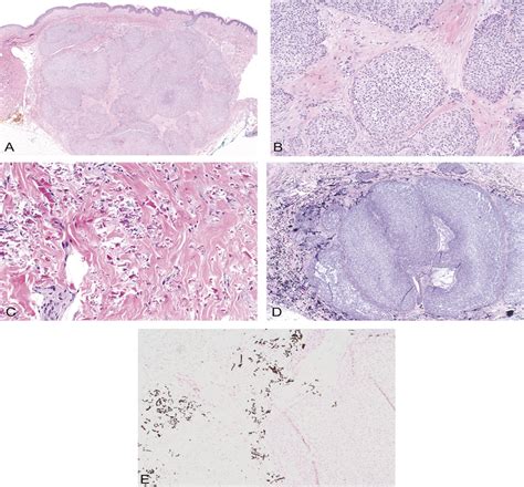 The American Journal Of Dermatopathology