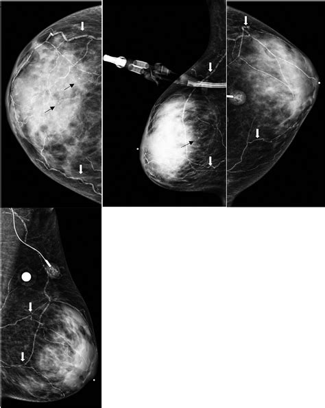 Figure 1 From Calciphylaxis Of The Breast Mimicking Advanced Breast Cancer With Skin