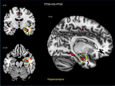 Resting State Functional Connectivity Results For The Right Flocculus