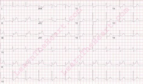 Inferior Posterior Wall Mi Ecg 1