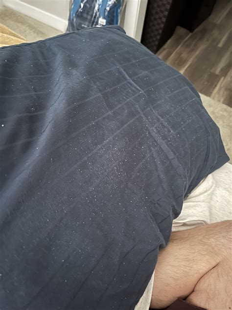 Dry Scalp Or Dandruff R Dandruff