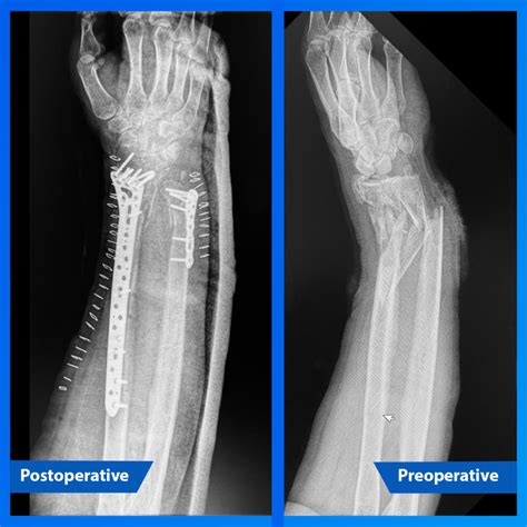Osteosynthesis Of Radius With Long Plate Inteos® Radius System Of Variable Angle With Screws