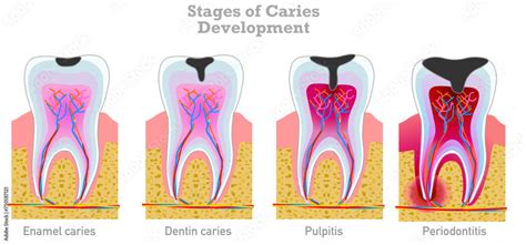 Caries Stages Development Tooth Decay Enamel Dentin Caries Pulpitis