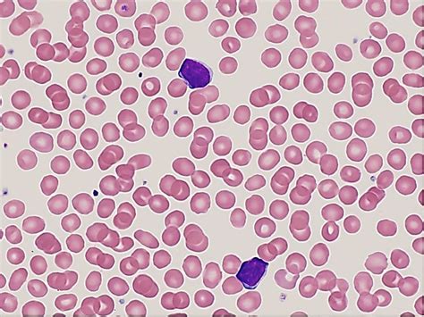 Atypical Lymphocytes