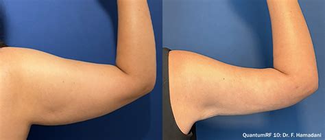 Quantumrf Integrated Aesthetics