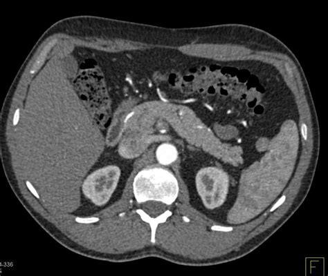 Uncinate Uncinate Process Of Ethmoid Bone Processus Uncinatus