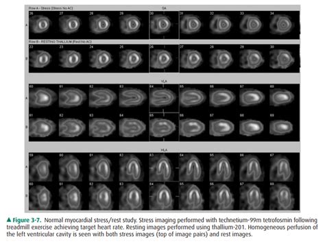 Techniques And Normal Anatomy Radionuclide Imaging Nuclear Medicine