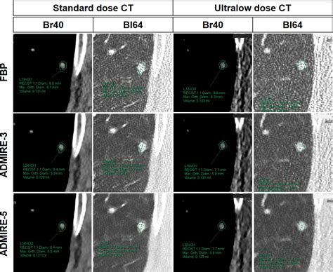 Semi Automated Volumetry Of Pulmonary Nodules Intra Individual
