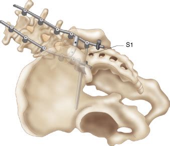 Pelvic Fixation Neupsy Key