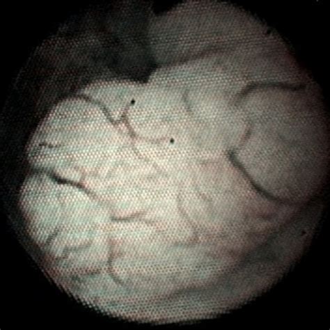 The Cerebroid Pattern Polypoid Endometrium With White Or Gray Color Download Scientific