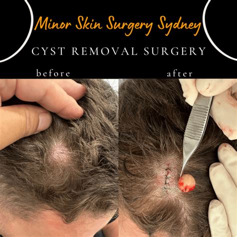 Cyst Surgery Cyst Removal Cyst Treatment Sydney