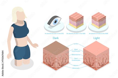 3d Isometric Flat Conceptual Illustration Of Albinism Compared Normal